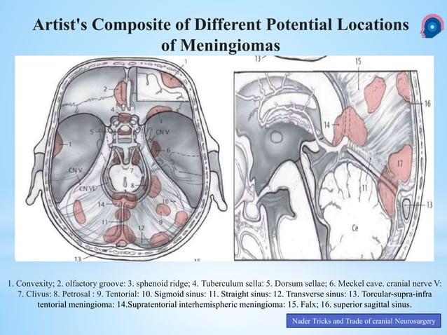 Meningioma of brain | PPTX