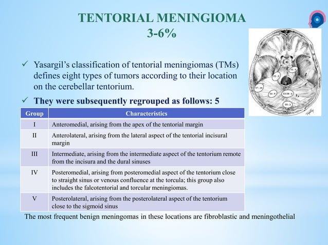 Meningioma of brain | PPTX