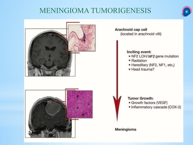Meningioma of brain | PPTX