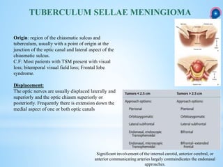 Tuberculum Sellae Meningioma