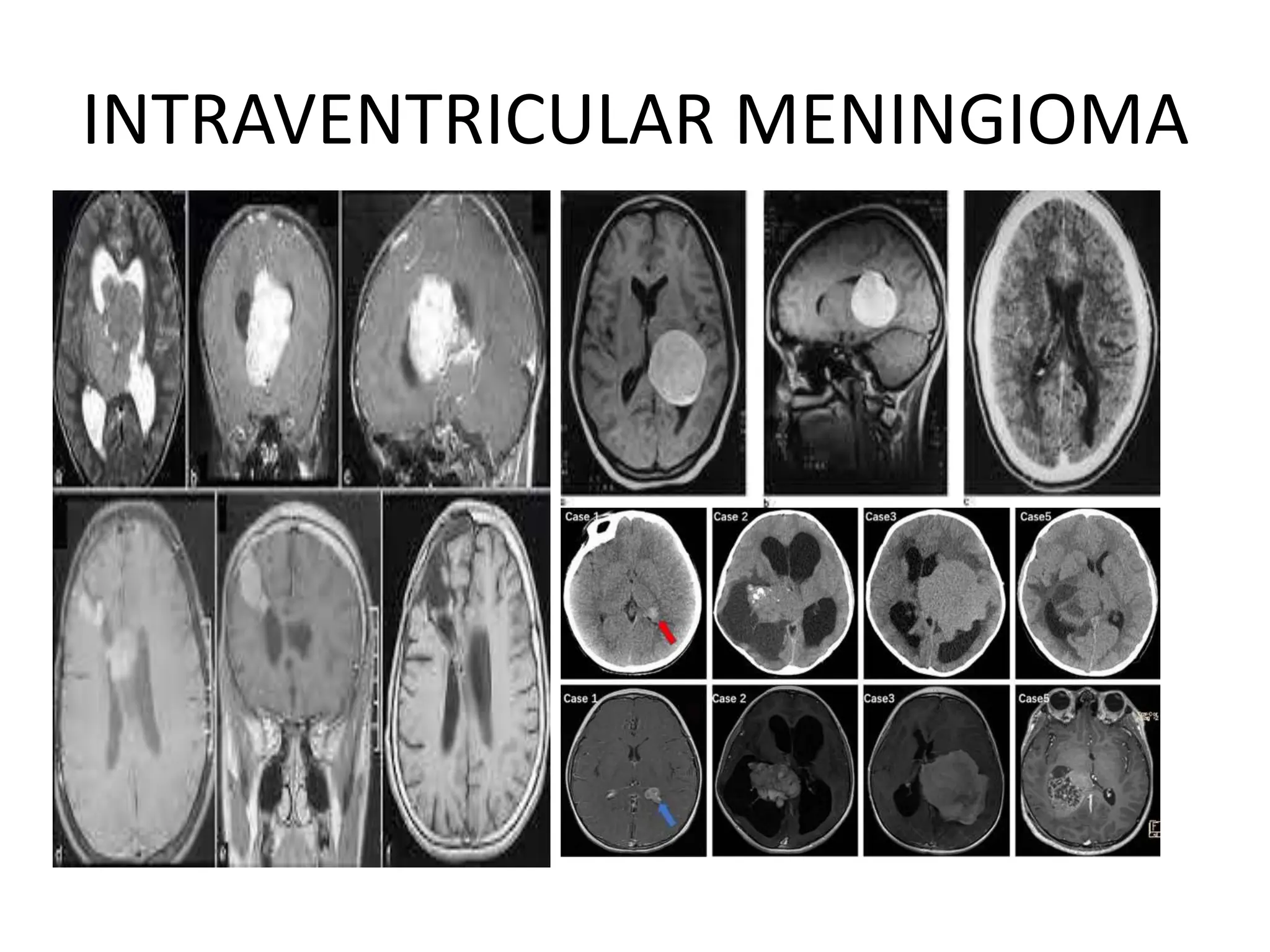 Meningioma presentation by dr,Mumtaz Ali narejo | PPTX