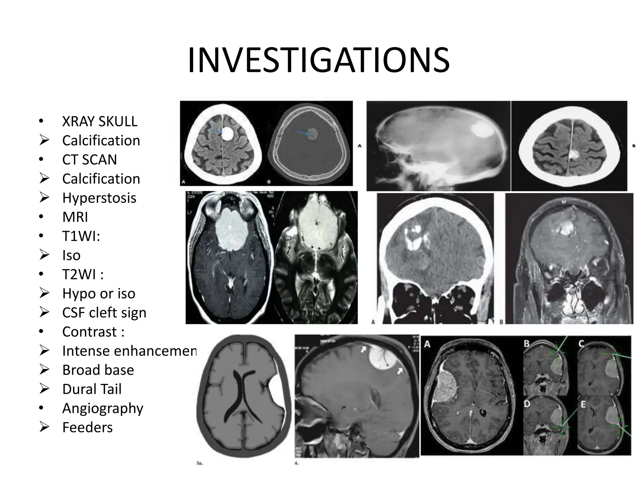 Meningioma presentation by dr,Mumtaz Ali narejo | PPTX