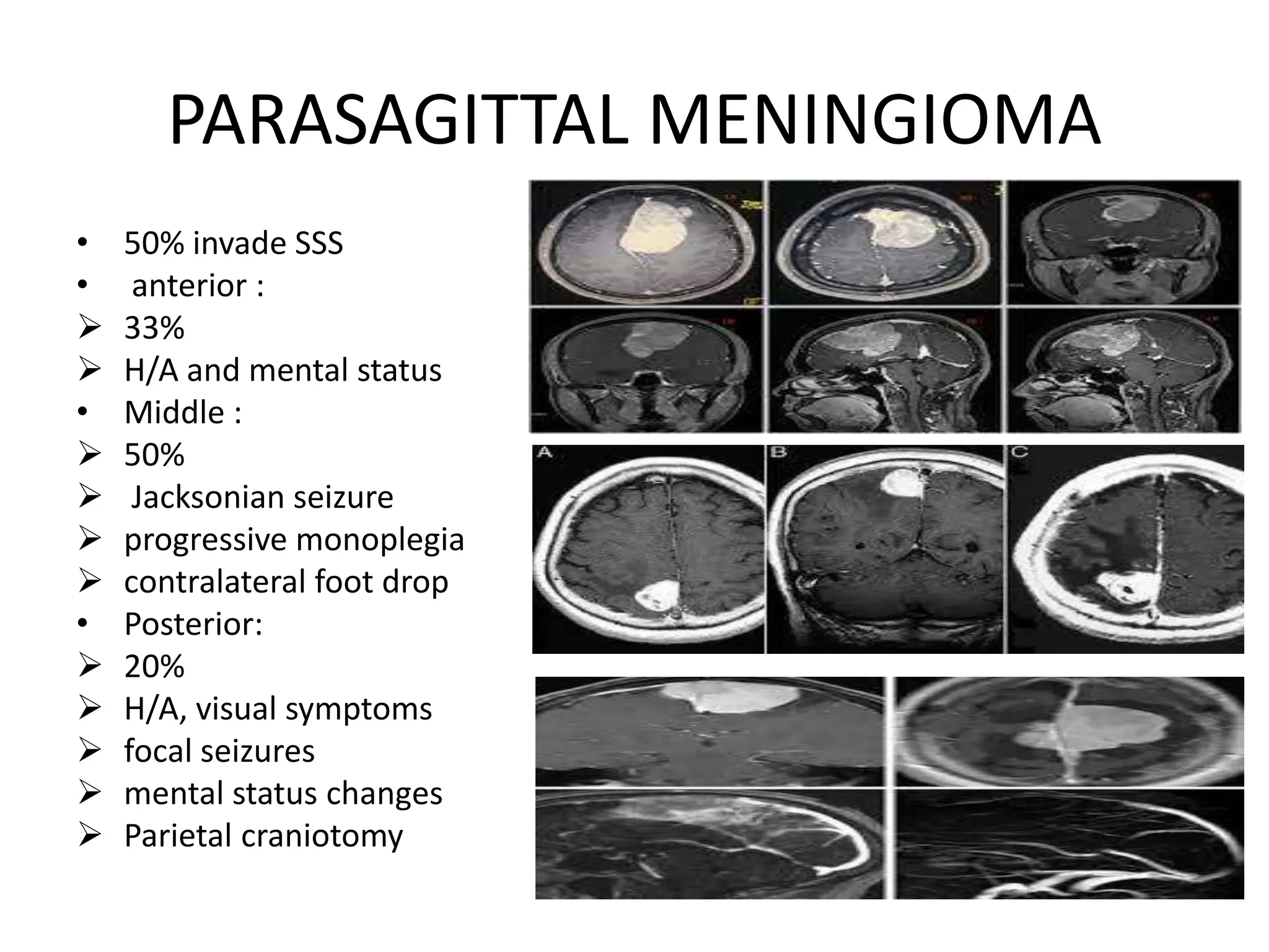 Meningioma presentation by dr,Mumtaz Ali narejo | PPT