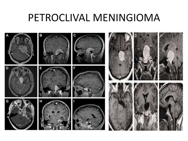 Meningioma presentation by dr,Mumtaz Ali narejo | PPT