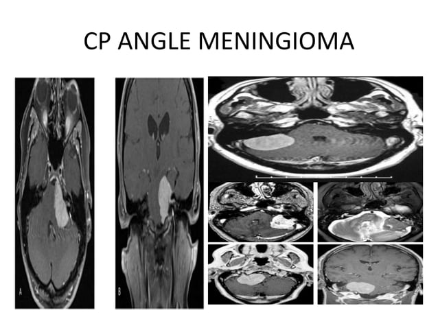 Meningioma presentation by dr,Mumtaz Ali narejo | PPT
