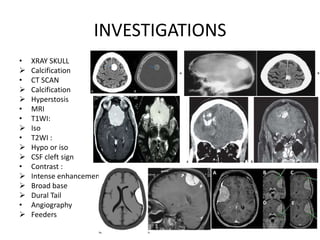 Meningioma presentation by dr,Mumtaz Ali narejo | PPT