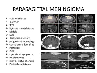 Meningioma presentation by dr,Mumtaz Ali narejo | PPT