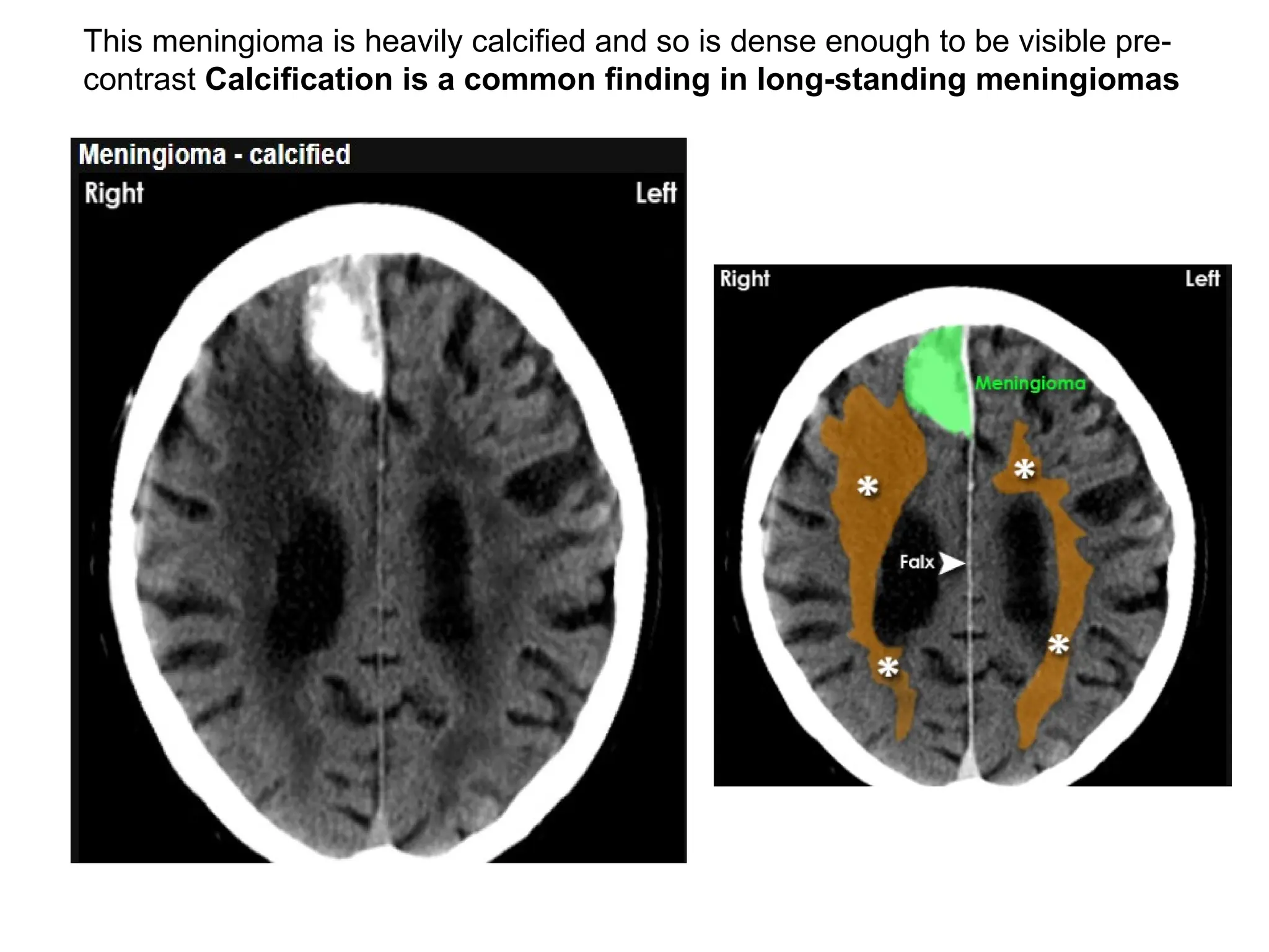 meningiomafinal-170205140136 (3).pptx MENINGIOMA | PPTX