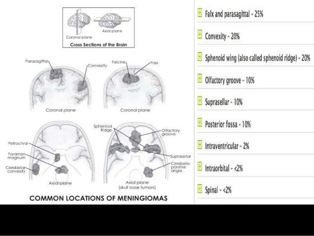 Meningiomas Fossa Posterior - Clivus / Petroclival / APC / Forame Mag…