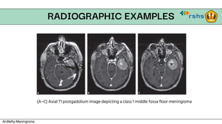 Meningiomas of the Middle Fossa Floor.pptx