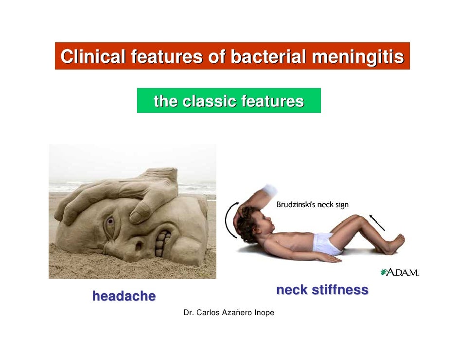 Meningitis Neck Stiffness Sign: Meningitis Sensitivity – MGNAR