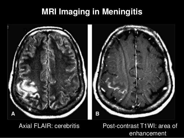 Meningitis