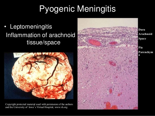 Meningitis