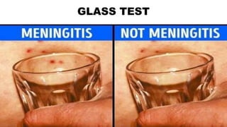 Meningitis Glass Test