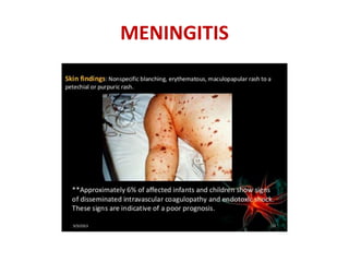 Meningitis | PPTX