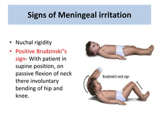 MENINGITIS.pptx