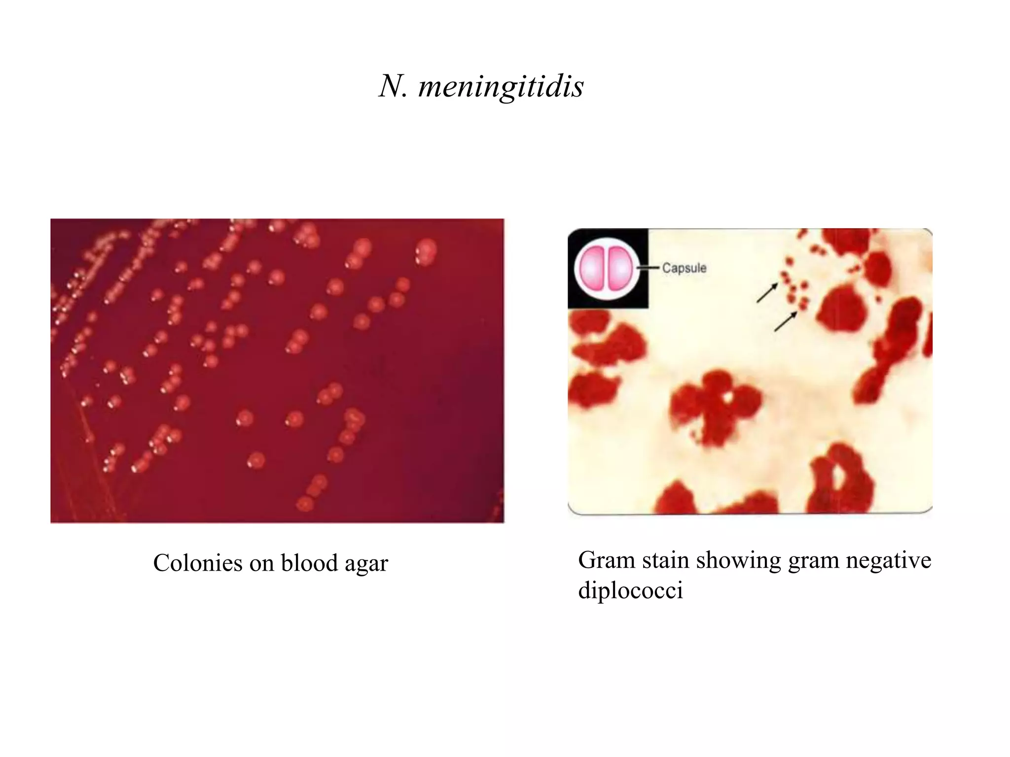 Meningitis | PPTX