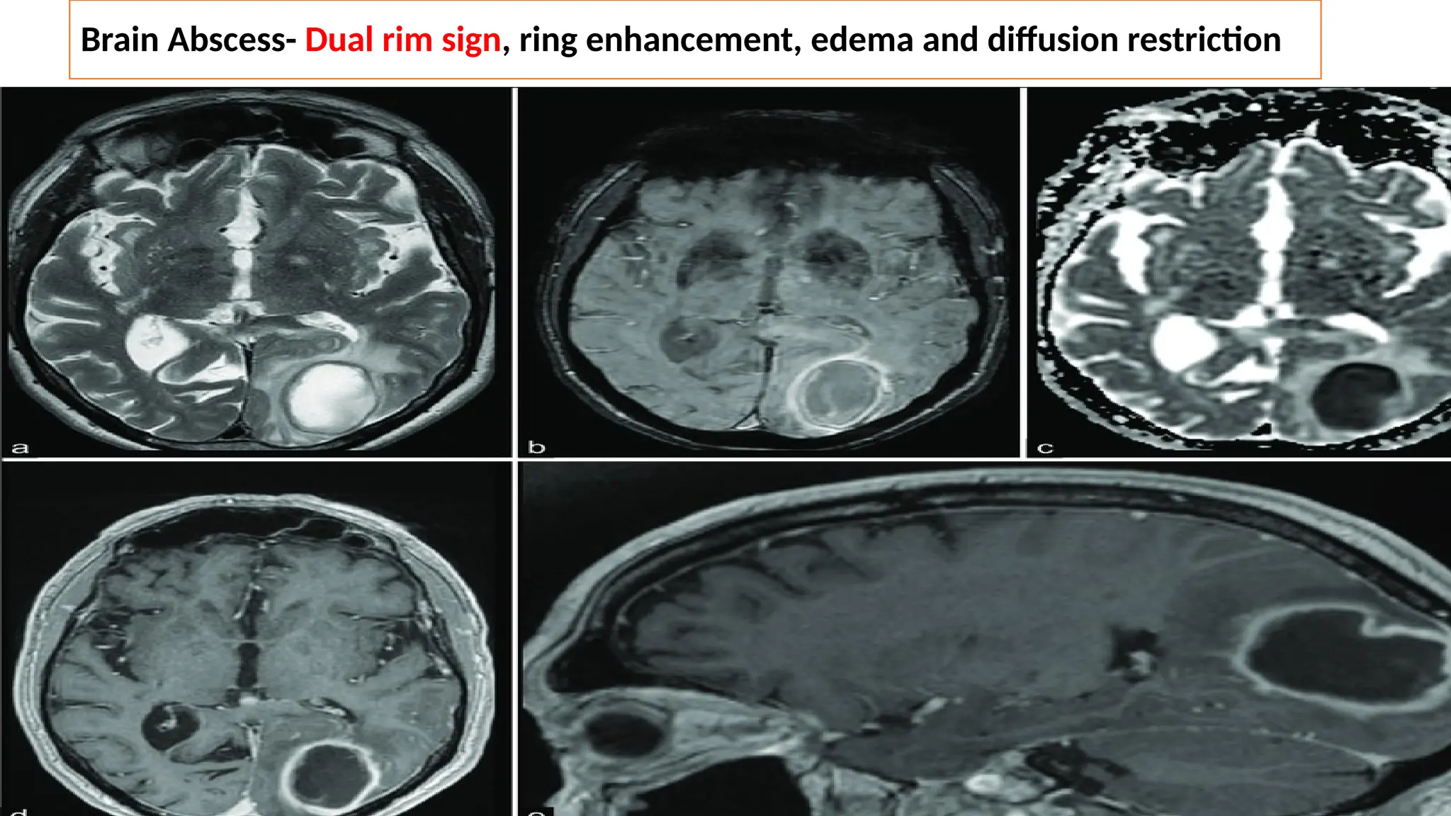 Meningitis.pptx approach to meningitis treatment | PPTX