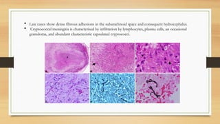 PATHOLOGY OF MENINGITIS TYPES ETIOLOGY.pptx
