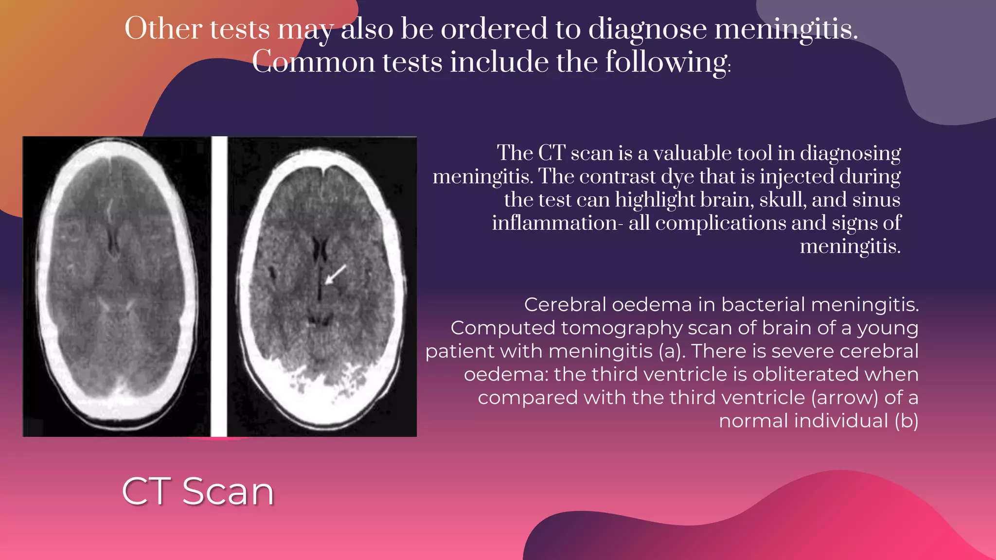 Meningitis .pptx