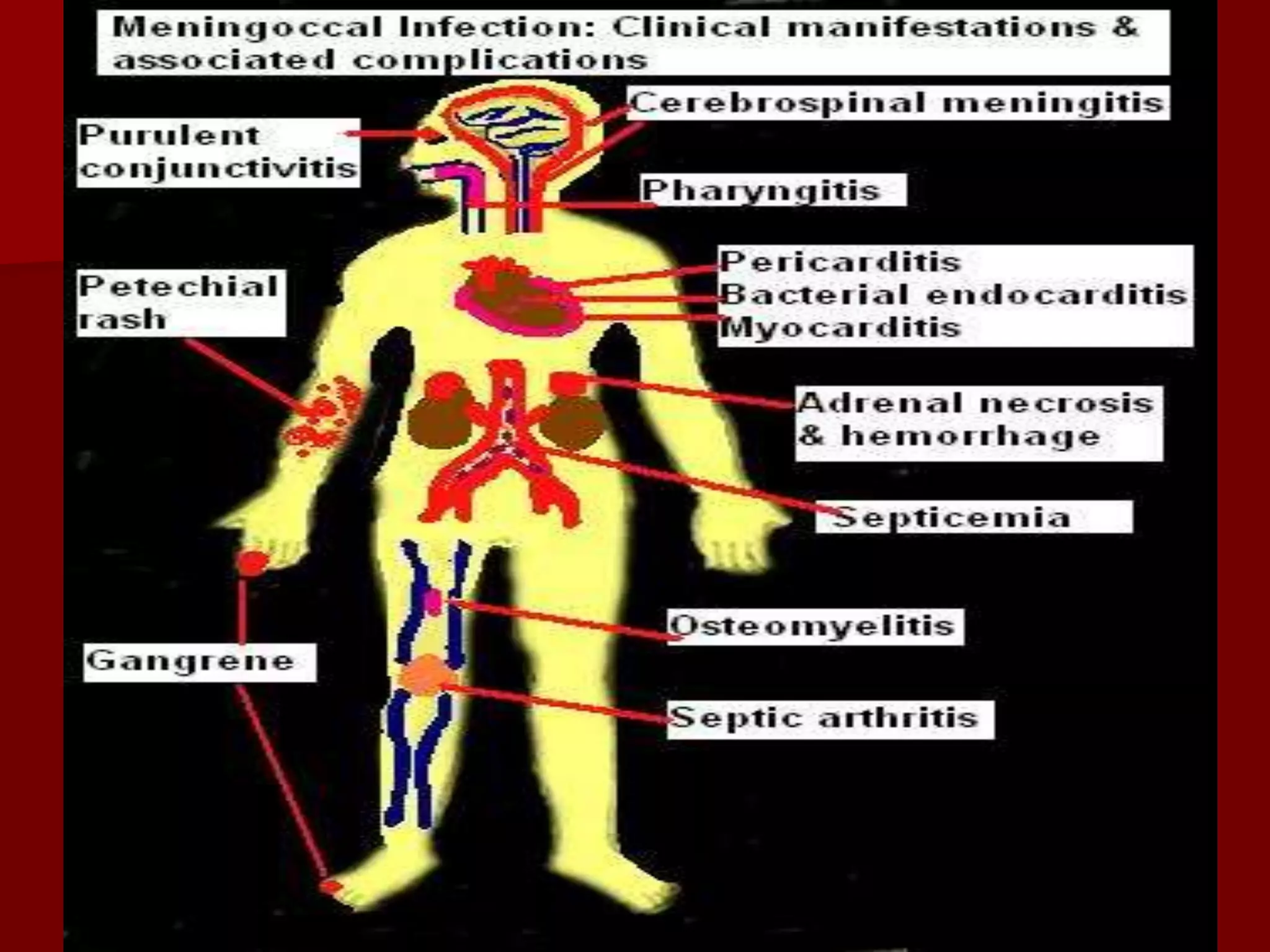 meningitis (5).pptx