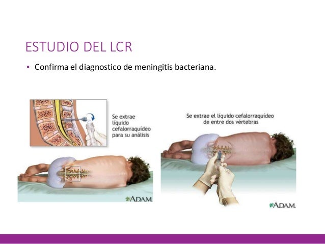 Meningitis bacteriana