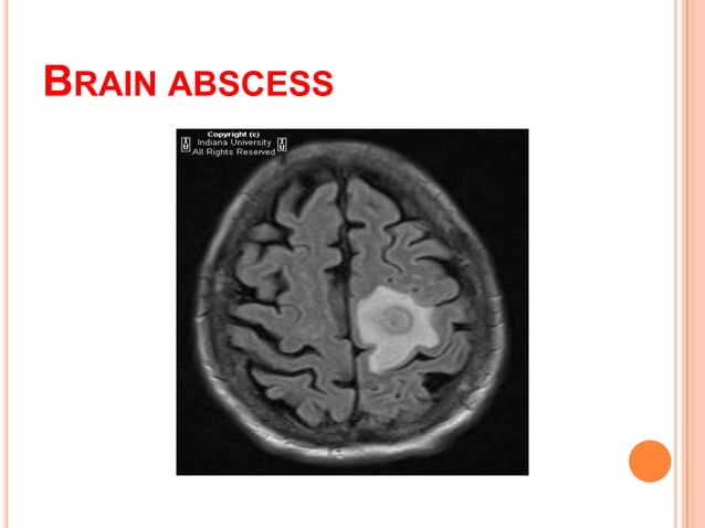 Meningitis brain abscess | PPTX