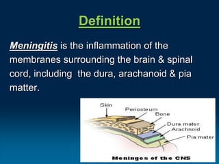 MENINGITIS IN CHILDREN | PPT