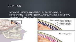 Meningitis in Children. | PPTX