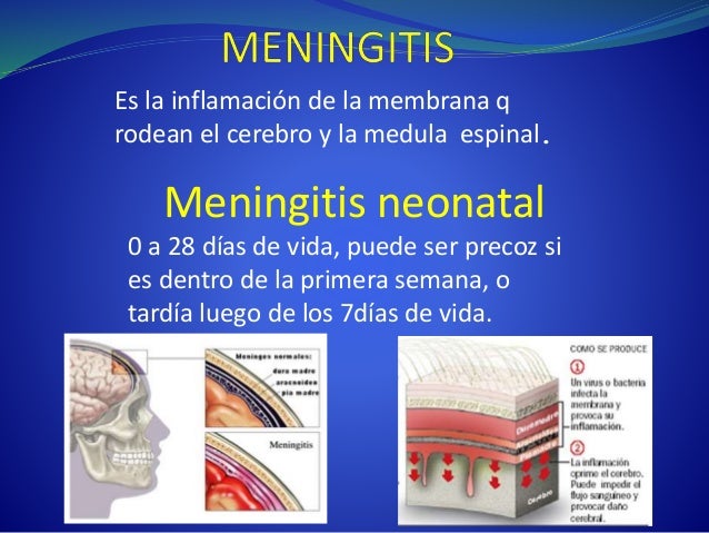 Meningitis neonatal