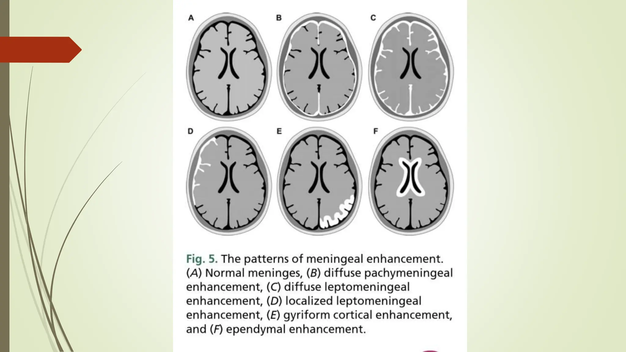 MENINGITIS NEUROIMAGING KRITIKA sms neurology ptx | PPTX | Brain and ...