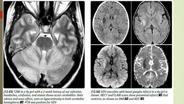 MENINGITIS NEUROIMAGING KRITIKA sms neurology ptx | PPT