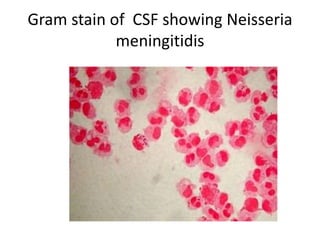 Meningitis ppt | PPTX