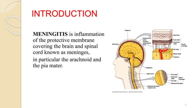 meningitis.pptx