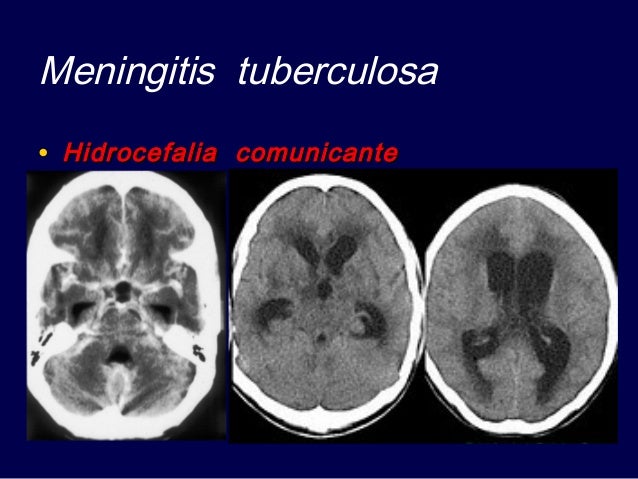 Meningitis tuberculosa