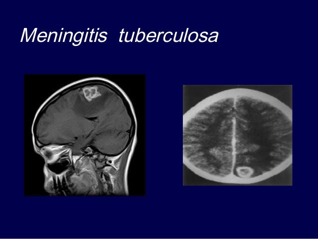 Meningitis tuberculosa