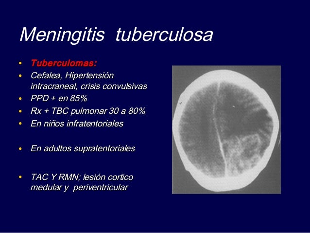 Meningitis tuberculosa