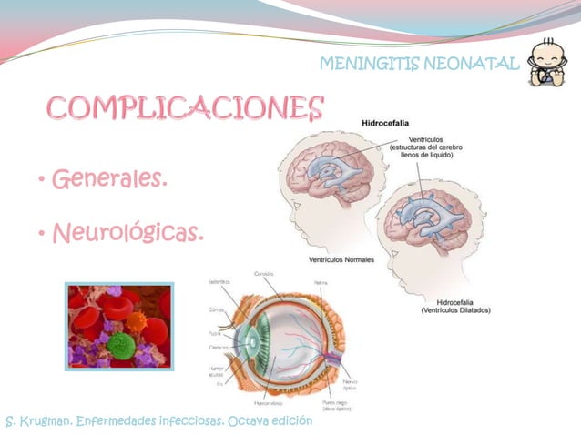 Meningitis Y Sepsis Neonatal | PPT | Descarga Gratuita