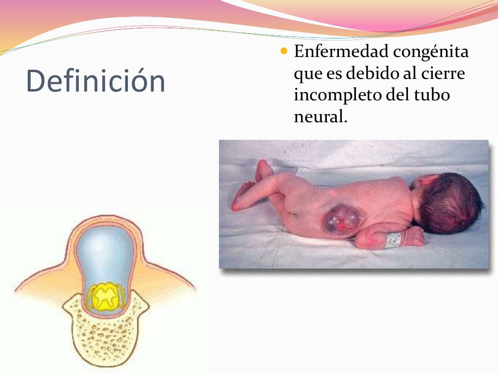 Cuidados de Enfermeria Meningocele