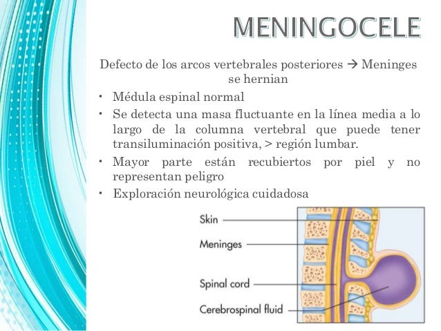 Meningocele Que Es