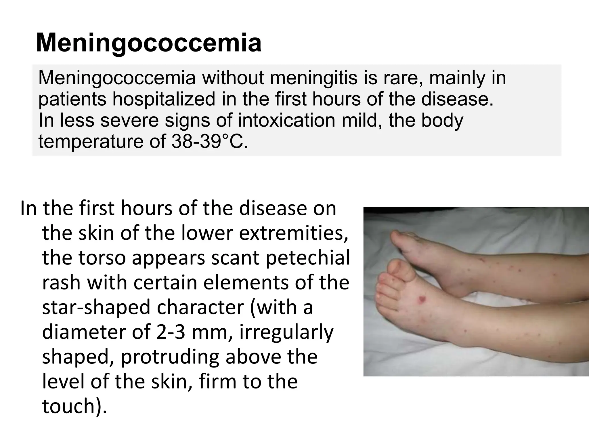 Meningococcal Disease_осн for students ppt | PPT