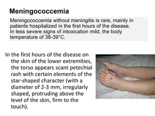 Meningococcal Disease_осн for students ppt | PPT