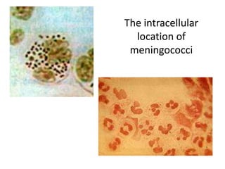 Meningococcal Disease_осн for students ppt | PPT