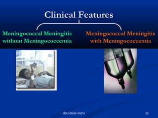 Meningo coccal meningitis | PPTX