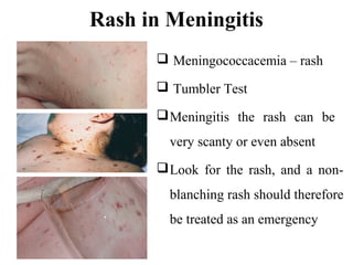 Meningococcal meningitis (dr.yla) | PPT