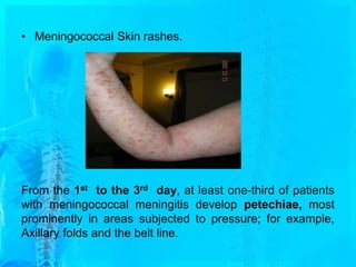 Meningoencephalitis in pediatric | PPTX