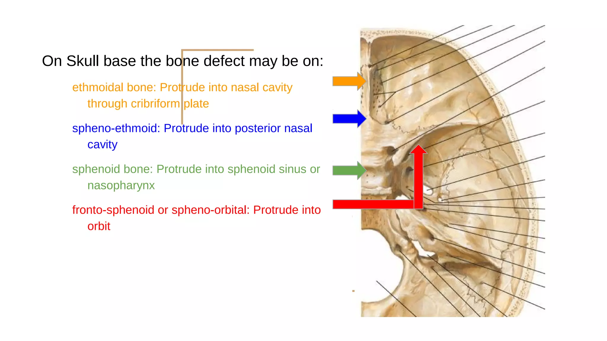 Meningoencephalocele | PPT