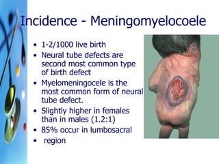 Meningomyelocoele | PPT