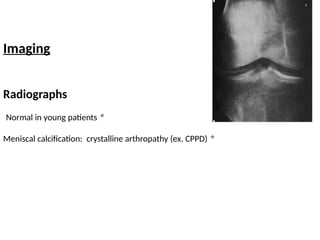 Meniscal Injuries fast review and treatment | PPTX