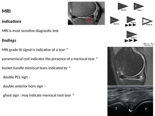 Meniscal Injuries fast review and treatment | PPTX
